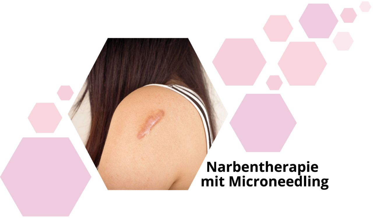 Narbentherapie mit Microneedling - FASCIEN-Nation Aesthetics